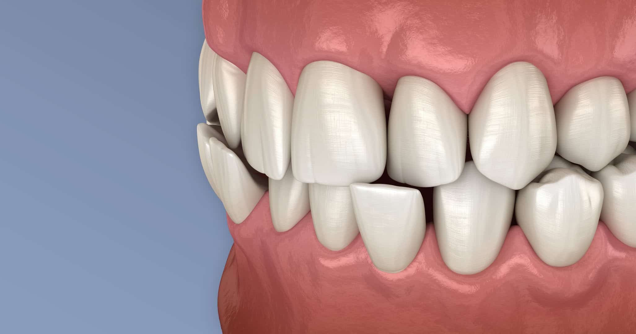 Crossbite Correction in Spokane, WA & Bite Alignment Treatment