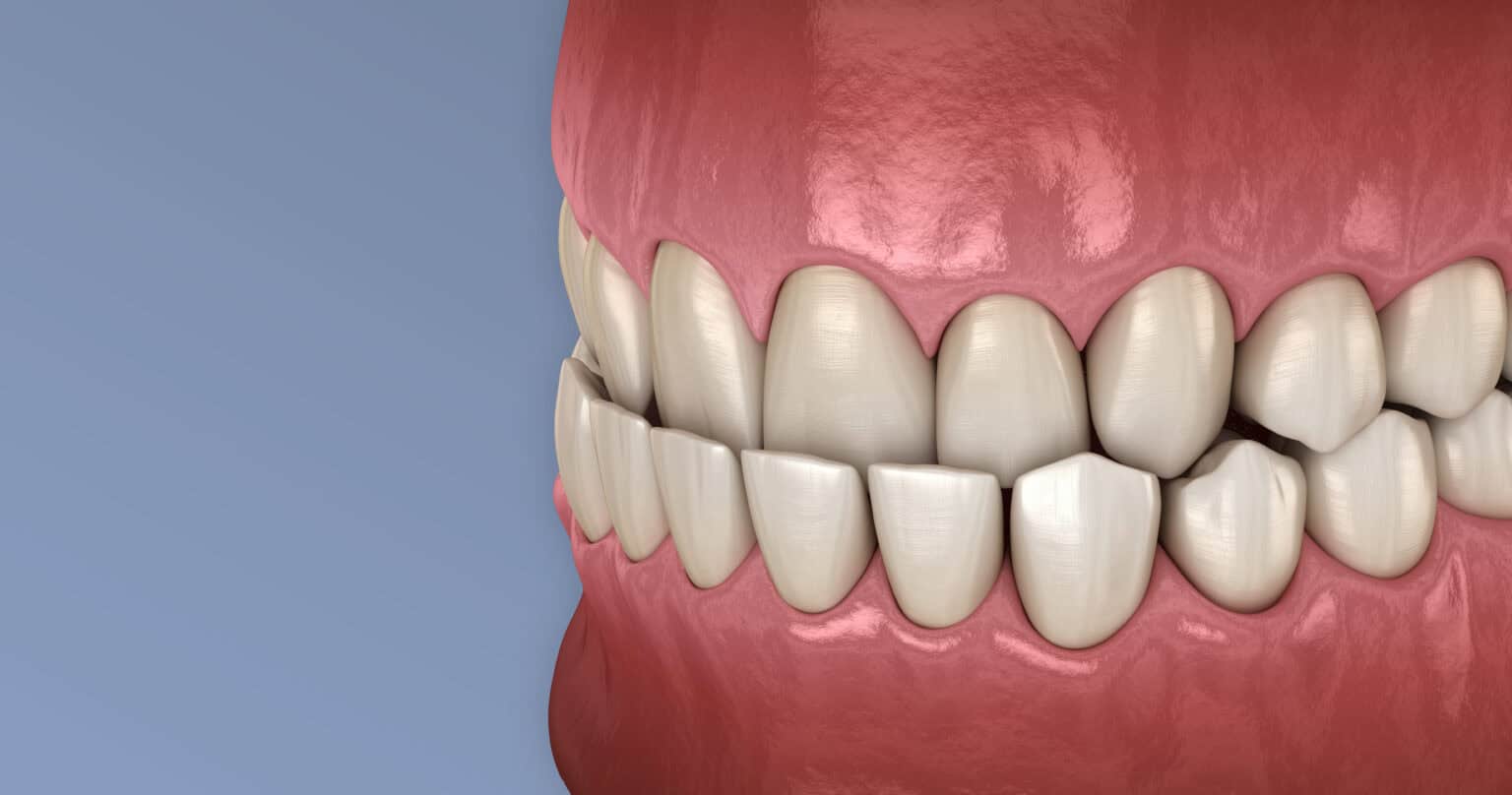 How to Fix Underbite in Spokane: Treatment & Surgery Options
