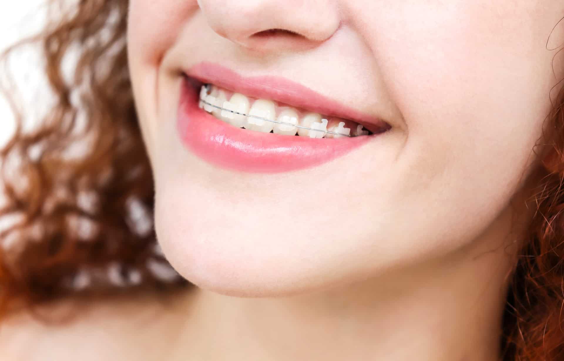Ceramic Braces in Spokane, WA - Hi 5 Orthodontics
